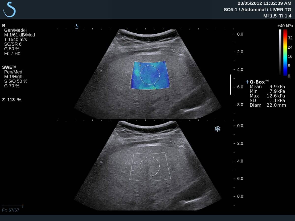 A Noninvasive Technique for Liver Diagnosis - Axis Imaging News