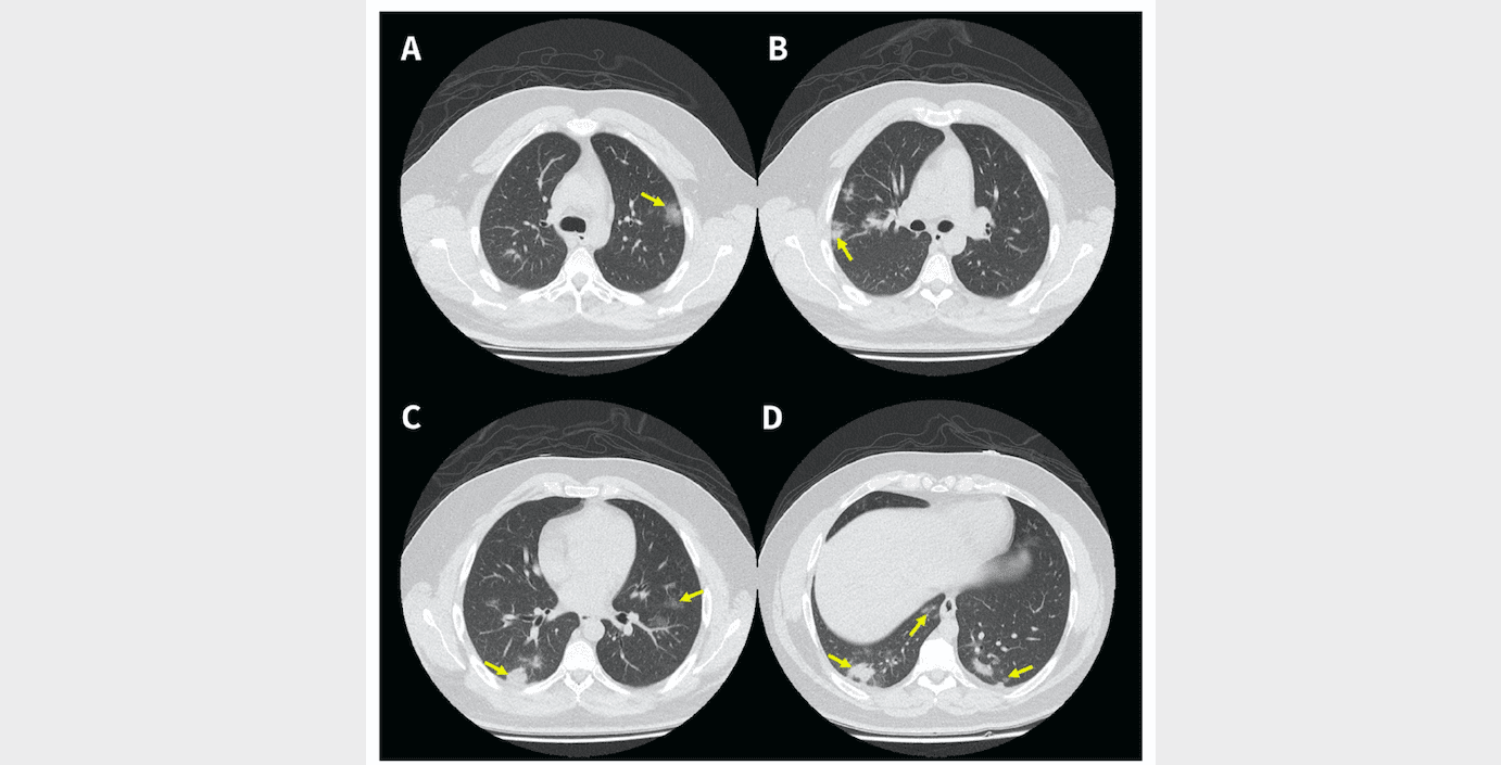 Case Report: Chest CT Images of a 28-Year-Old Man with COVID-19 - Axis ...