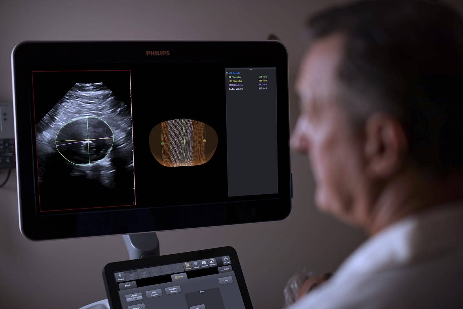 Philips Integrates 3D Ultrasound with Software for Surveillance of ...