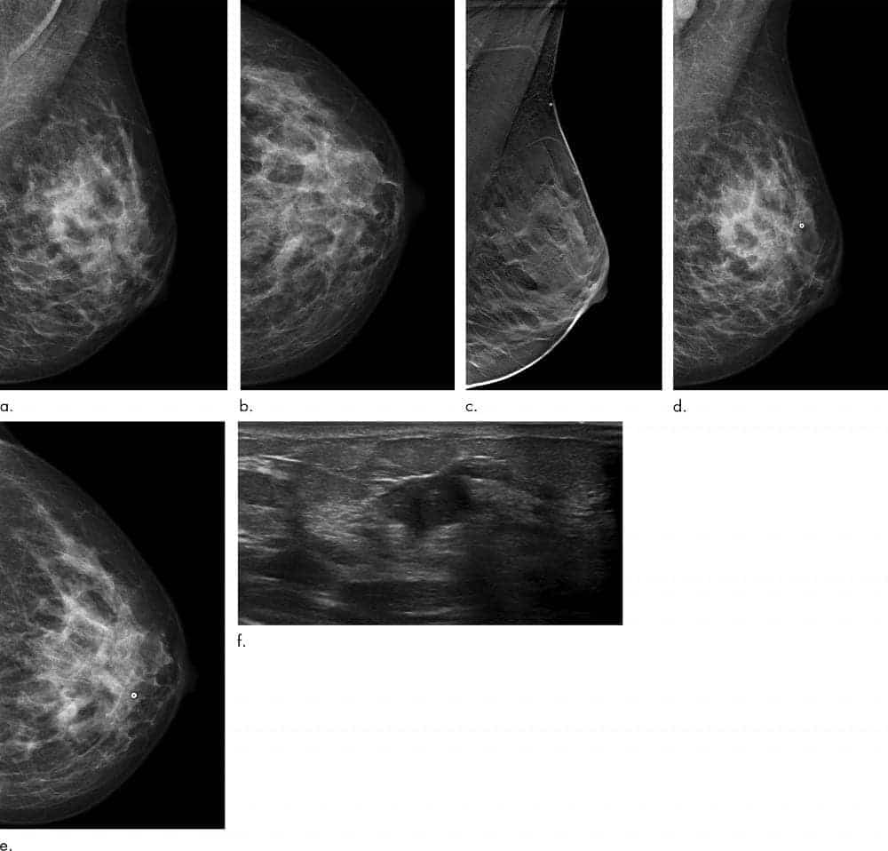 Digital Breast Tomosynthesis Reduces Rate of Interval Cancers - Axis ...