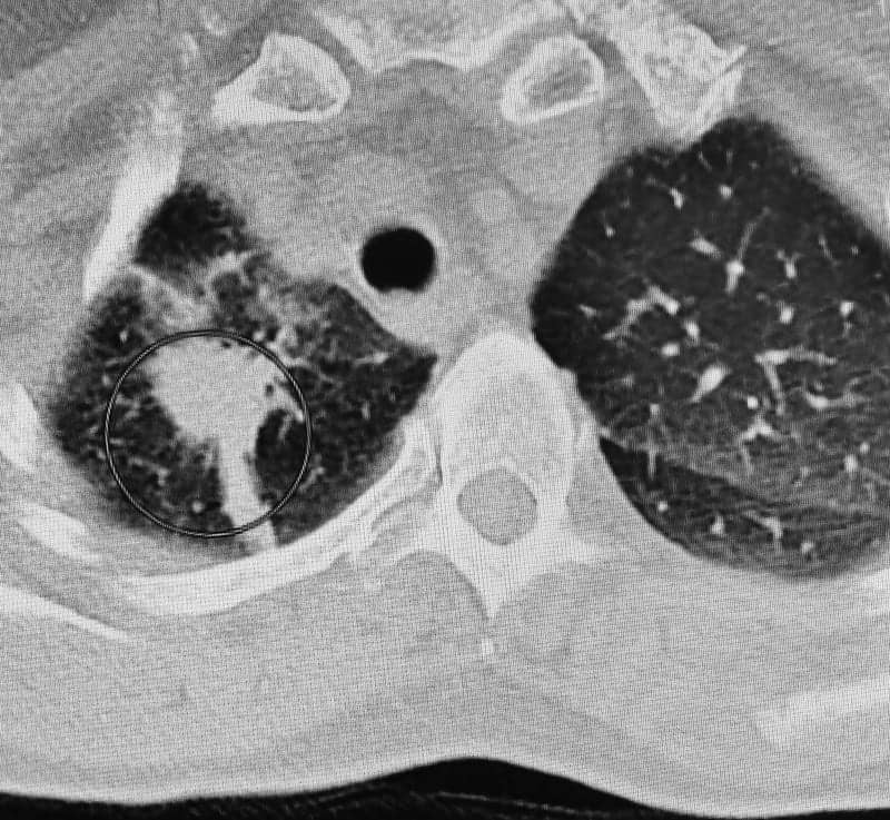 ACR Urges Radiologists to Provide Input to CMS Lung Cancer Screening ...
