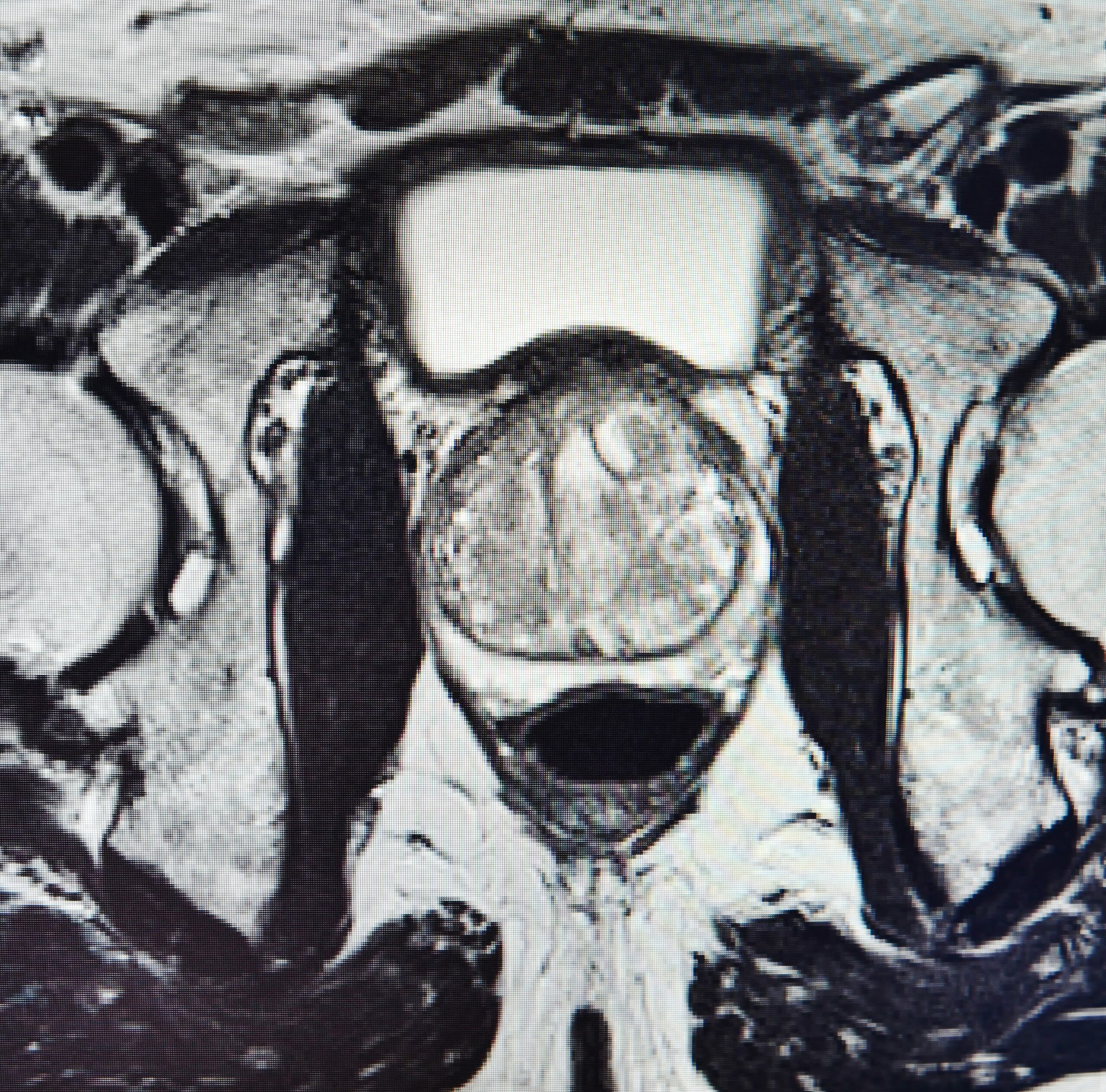 Research Finds Prostate Artery Embolization As Most Effective Treatment