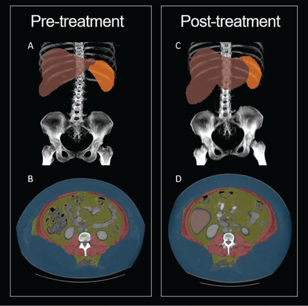 Semaglutide Therapy Changes CT Body Composition - Axis Imaging News