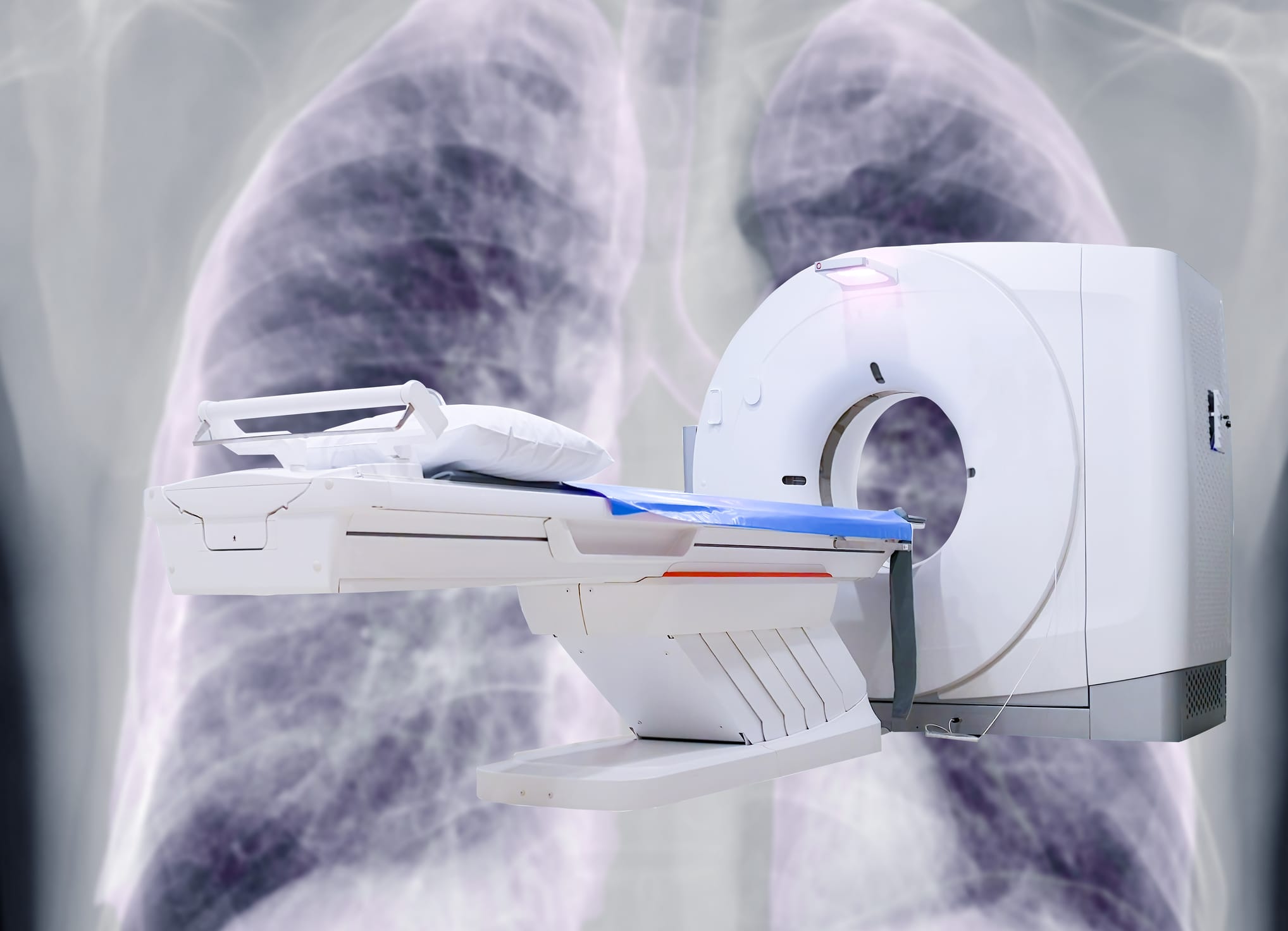 Photon-counting CT Outperforms Conventional CT in Lung Cancer ...